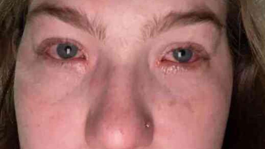 "Soy alérgica a mi novio": la historia de una joven con extraños ...