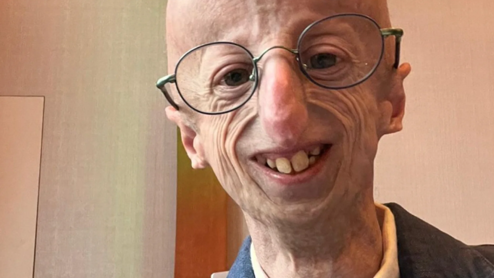 Qué es la progeria, la enfermedad ultrarrara que tenía Sammy Basso ...