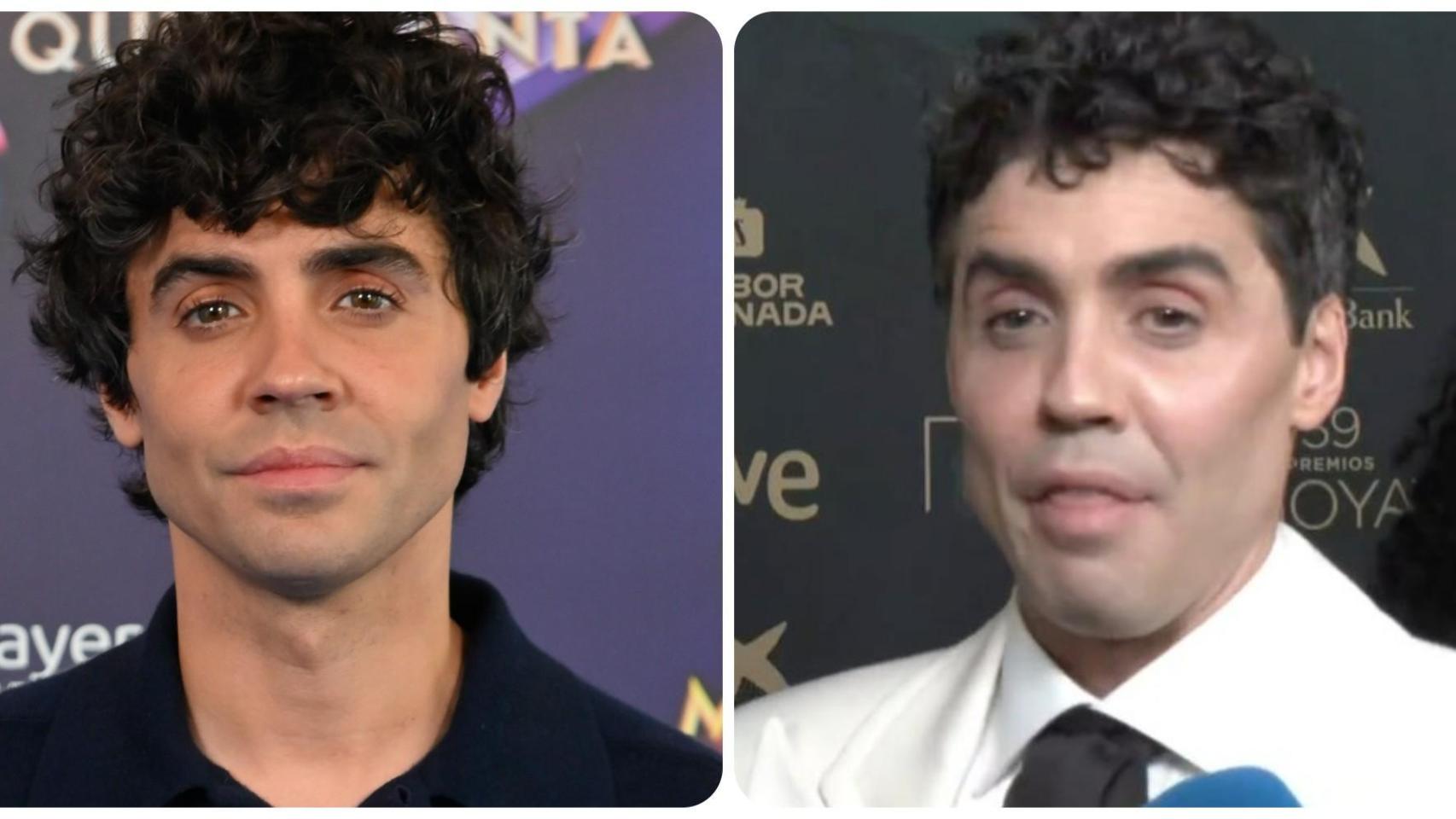 Qué se ha hecho Javier Ambrossi en la cara: este es el tratamiento al ...