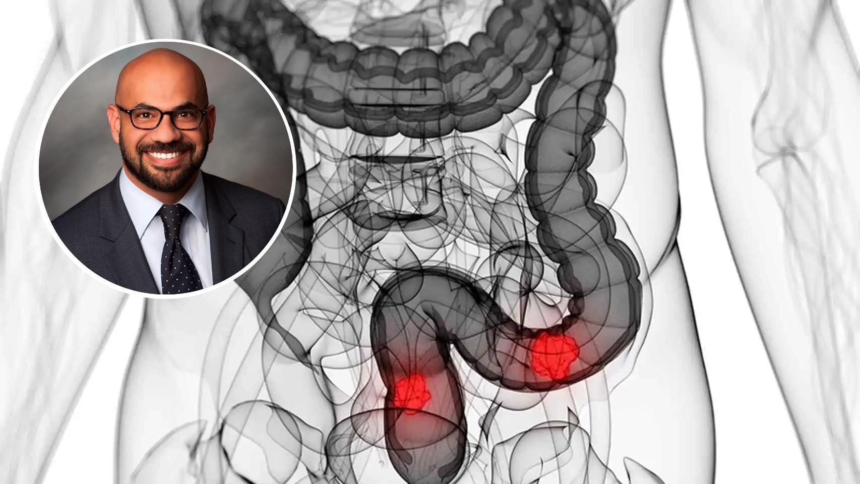 Las cinco señales que se vinculan con el cáncer de colon en España ...